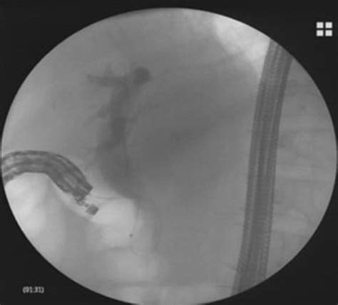 Endoscopic Ultrasound Guided Rendezvous Technique Under Real Time Eus Download Scientific