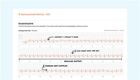 Sinus Rhythm Vs Sinus Tachycardia On Your Watch Ecg Qaly