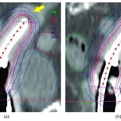 3d hdr icbt dose volume histogram comparing 192ir and 60co