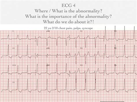 Ecg Quiz Pdf