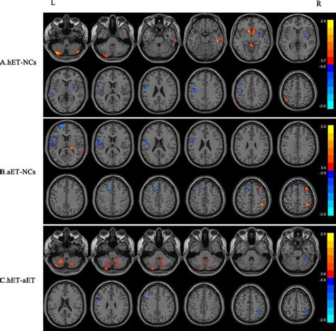 Statistical Parametric Map Showing The Significant Differences In The