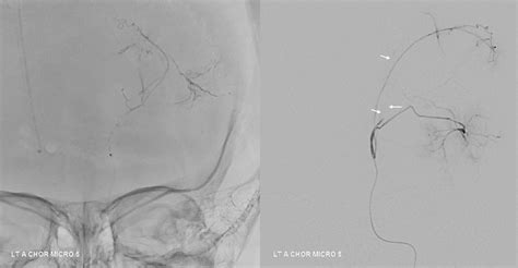 Choroid Plexus Papilloma Preoperative Embolization