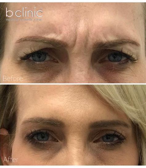 Frown Lines Treatment Brisbane Gold Coast Bclinic