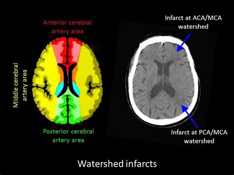 Infarct At Aca Mca Watershed Area Watershed Infarcts Watershed Area