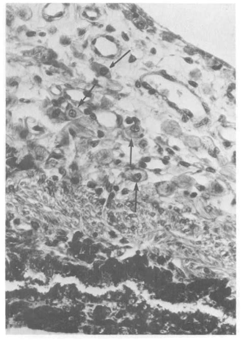 Figure From Feline Uveal Melanoma Model Induced With Feline Sarcoma Virus Semantic Scholar