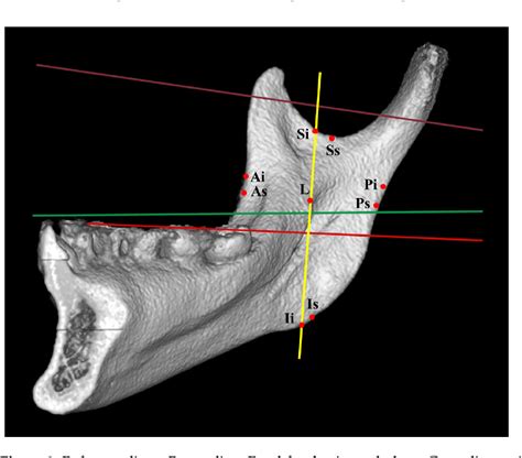 Figure 2 From Locating The Mandibular Lingula Using Cone Beam Computed Tomography A Literature