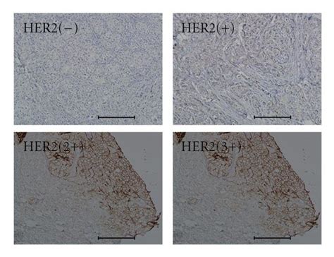 Accurate Her2 Testing By Qds Ihc A Specimens With Difference Her2