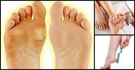 How To Get Rid Of Calluses Dr Farrah MD