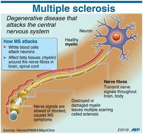 What Is Multiple Sclerosis