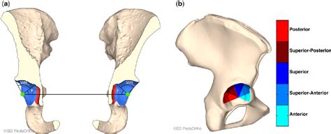 Figure 1 From Assessment Of Three Dimensional Acetabular Coverage