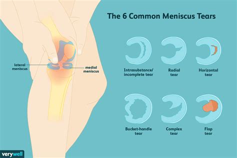7 Types Of Meniscus Tears And Treatments