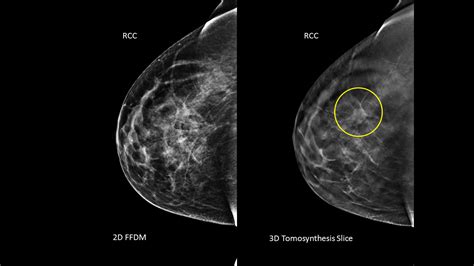 3d Mammography Significantly Increases The Detection Of Breast Cancer
