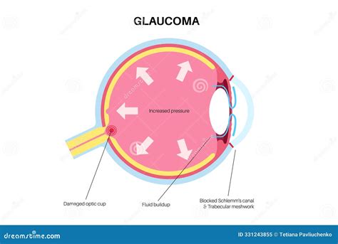 Presión Ocular Glaucoma Ilustración Del Vector Ilustración De Vector