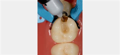 Closing The Class 2 Restoration Box Part 3 Restoring The Proximal Box