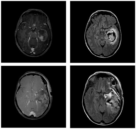 Brain Anatomy Mri