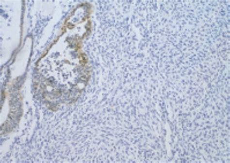 Morphology Of Biphasic Pb By Ihc 10×10 Download Scientific Diagram