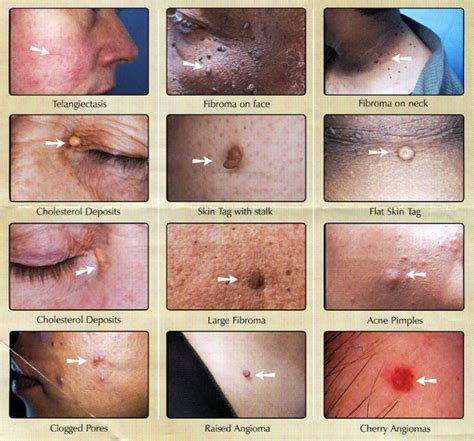 Skin Lesions Removal Organic Spa Houston Best Facials Brows Lashes