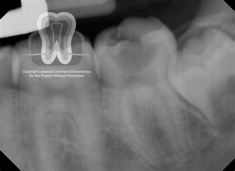 Un Intentional Revascularization Leawood Commons Endodontics