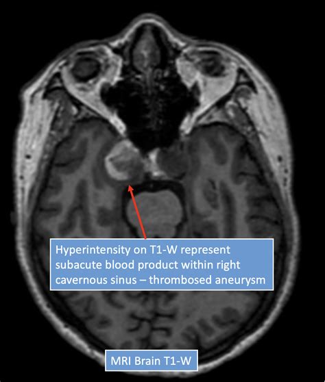 Radiopaedia Internal Carotid Artery Segments At John Hipple Blog