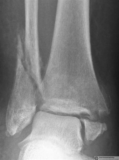 Pin On Orthopaedic Surgery