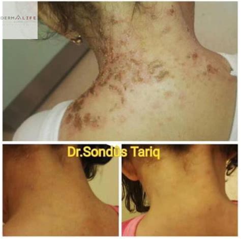 صور 📸 قبل وبعد لطفلة Dermalife Clinic عيادة ديرما لايف