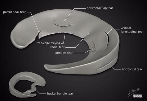 Different Types Of Meniscal Tears
