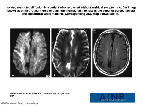 Isolated Restricted Diffusion In A Patient Who Recovered Without Residual Symptoms A DW Image