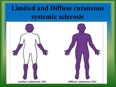 Systemic Sclerosis