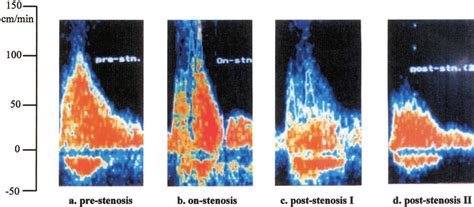 Characterization Of Doppler Waveform At Different Zones Along The Download Scientific Diagram