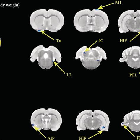 Typical Abr Waveforms In The Nihl Group And Hcs Group At 6 Months