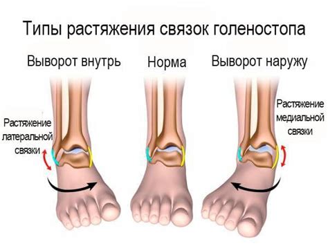 Тейпирование голеностопного сустава при растяжении связок — статьи от ...