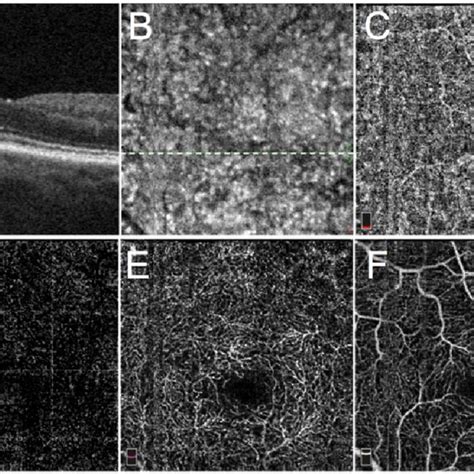 Type Iii Choroidal Neovascularization Cnv In Exudative Age Related