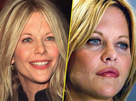 Photos Injections Labiales 31 Avantaprès De Stars Qui Vont Vous
