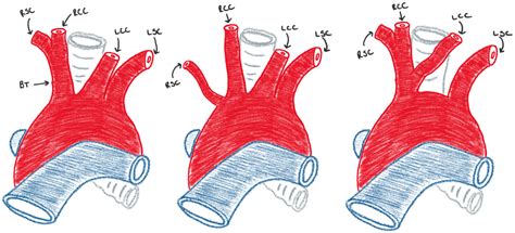 Introduction To Anatomical Variation Anatomical Variation An