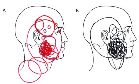 Could Reported Sex Differences In Hypertonic Saline Induced Muscle Pain