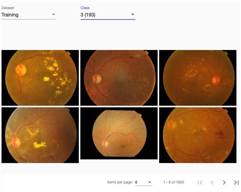 Blindness Detection With Artificial Intelligence Intelec AI Blog