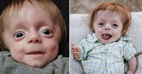 Un Nouveau Né Avec Une Maladie Osseuse Défit Le Pronostic Des Médecins Donnons Lui De Lamour