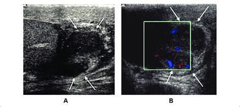 A Abnormal Left Epididymis Arrows Pointing To The Enlarged Mixed