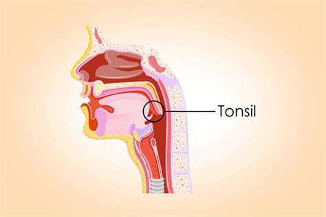 Icd 10 Coding Tip Tonsillitis Aapc Knowledge Center