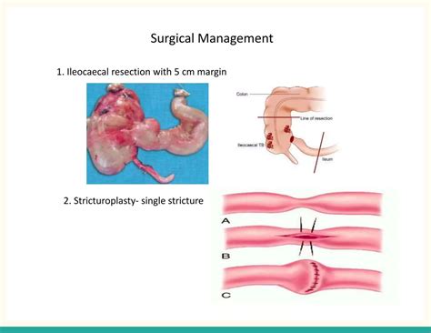 Tb And Typhoid Lesions Of Small Intestine Pptx