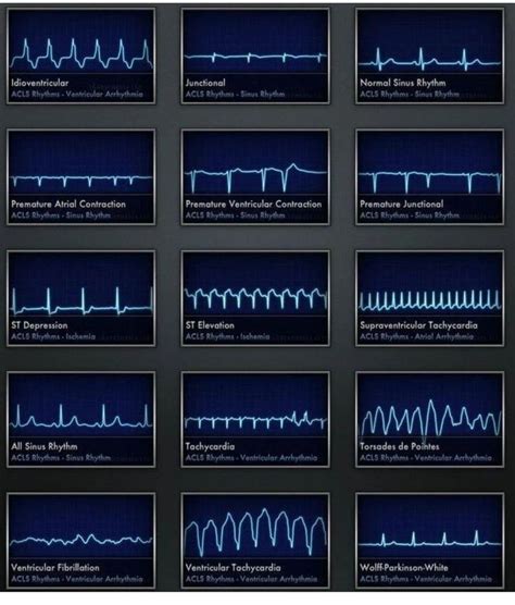 Common Cardiac Rhythms Medizzy
