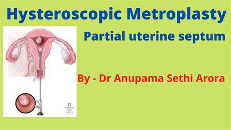 Hysteroscopic Metroplasty Partial Uterine Septum By Dr Anupama Sethi Arora Youtube