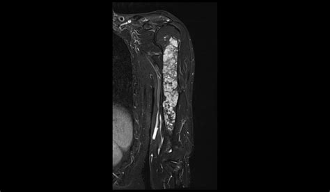 Polyostotic Fibrous Dysplasia Mri Radiology Article On Polyostotic