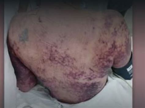 Perth Mother Dies From Dog Bite Infection Nt News