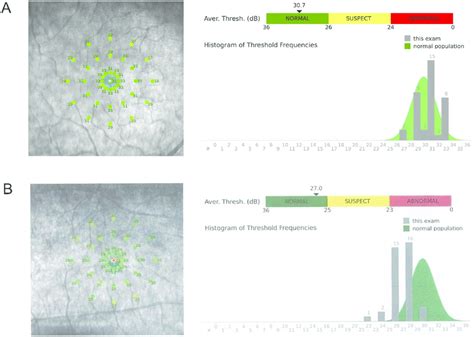 Evaluation Of Retinal Sensitivity The Retinal Sensitivities Were