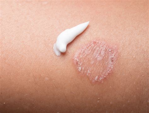 Difference Between Necrotizing Fasciitis And Cellulitis Difference Between Necrotizing