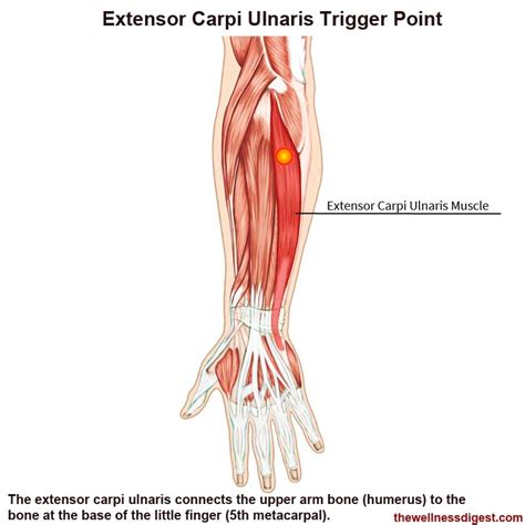 Extensor Carpi Ulnaris Muscle Pain The Wellness Digest