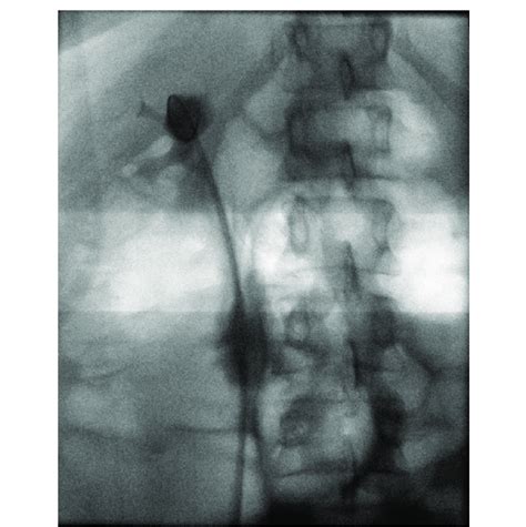 Retrograde Pyelogram Demonstrating Extravasation Of Contrast At Download Scientific Diagram