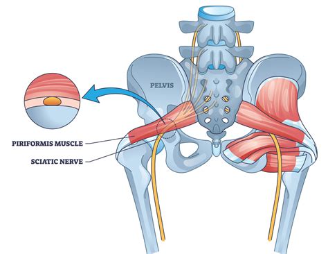 Piriformis Syndrome Rehabilitation Exercises Illustration