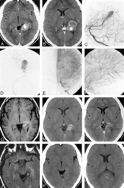 Posterior Cerebral Artery Segments